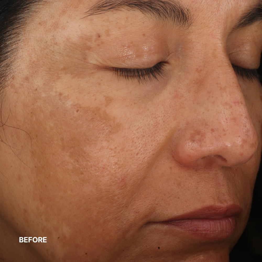 Malassezin: The Skin Brightening Ingredient | Mother Science